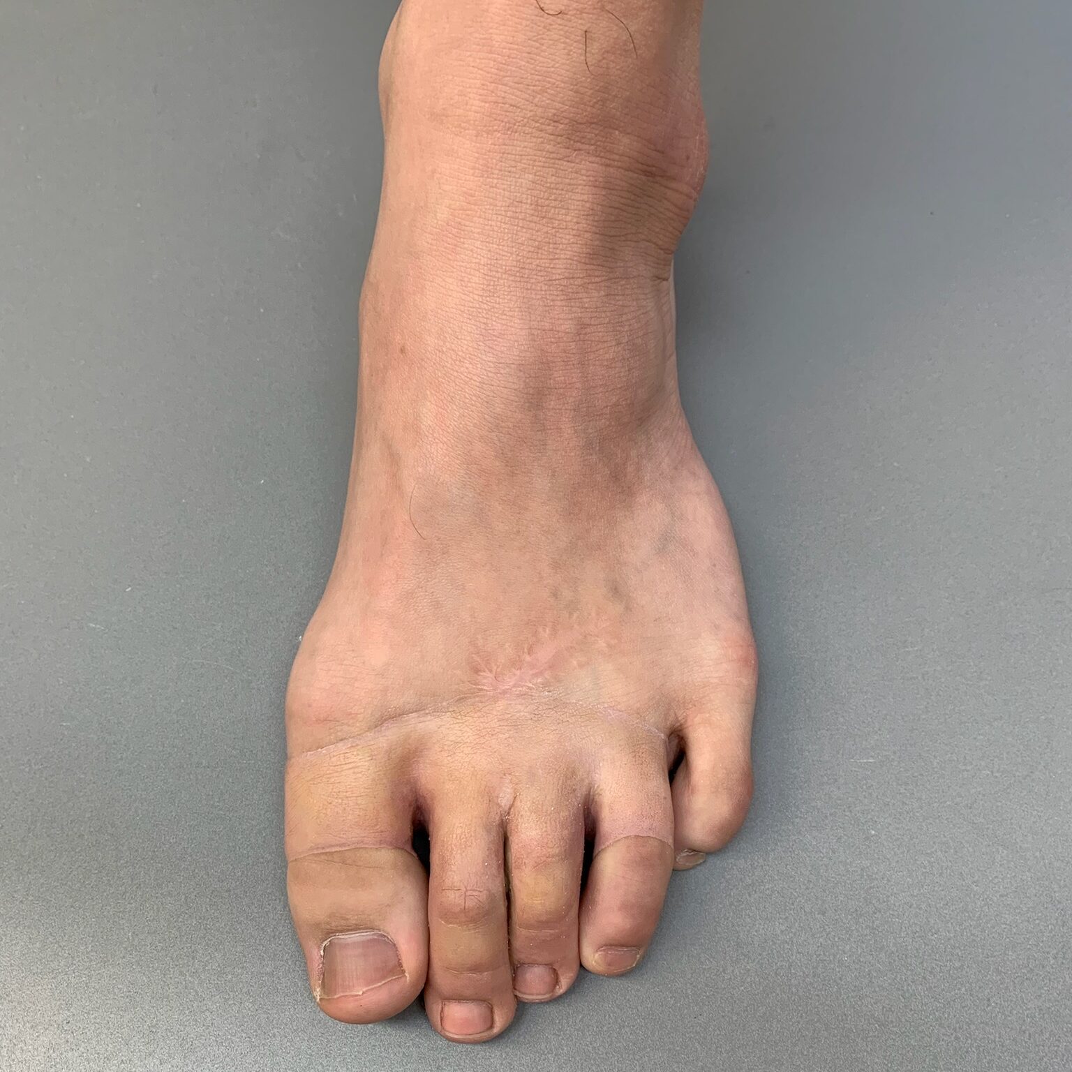 Toes - Aesthetic Prosthetics Inc®